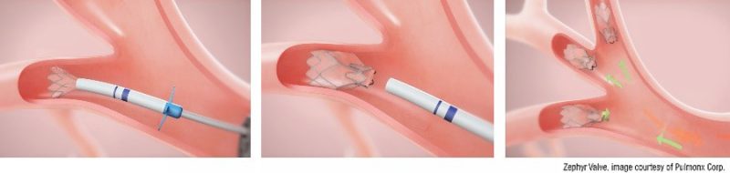 PCCS SERVICES – Pulmonary & Critical Care Specialists, PC | Novi Sleep ...